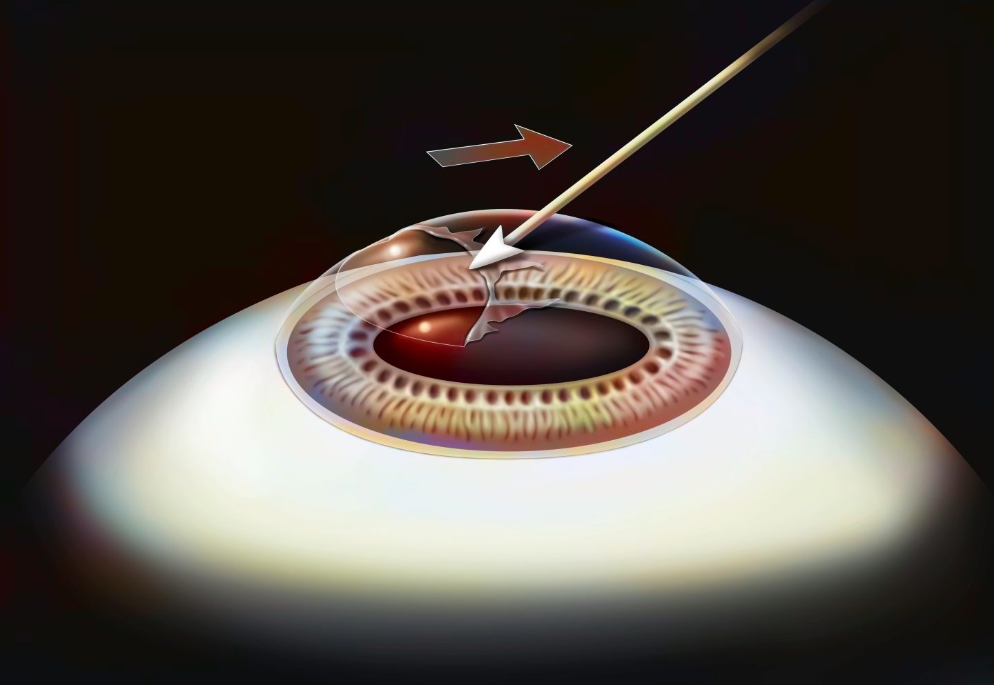 The History of LASIK Eye Surgery? | LASIK