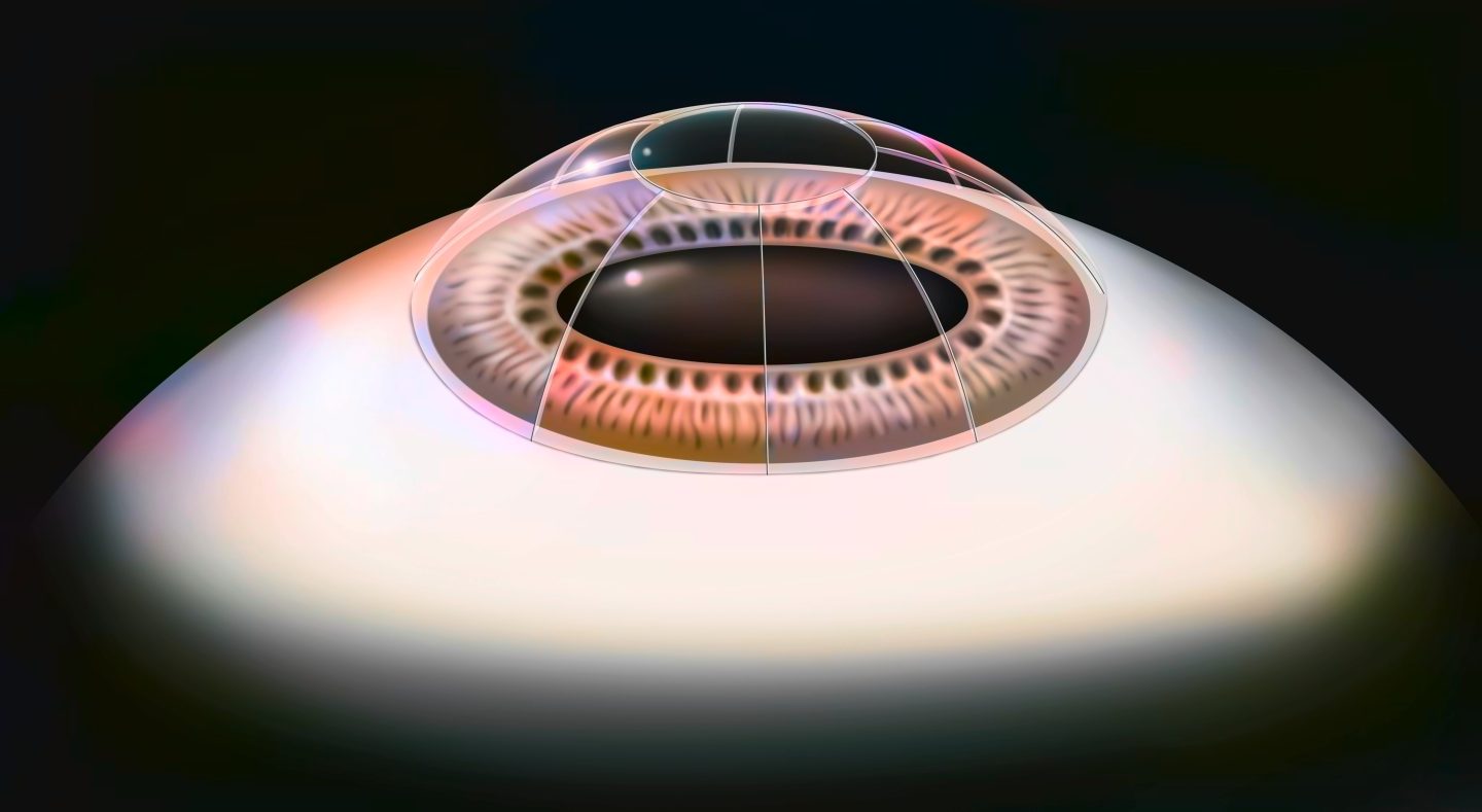 The History of LASIK Eye Surgery? | LASIK.com™ Official Site