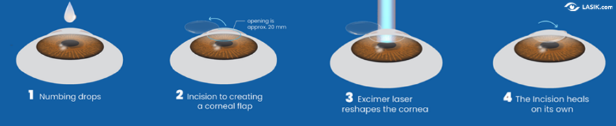 How Does LASIK Eye Surgery Work? | LASIK