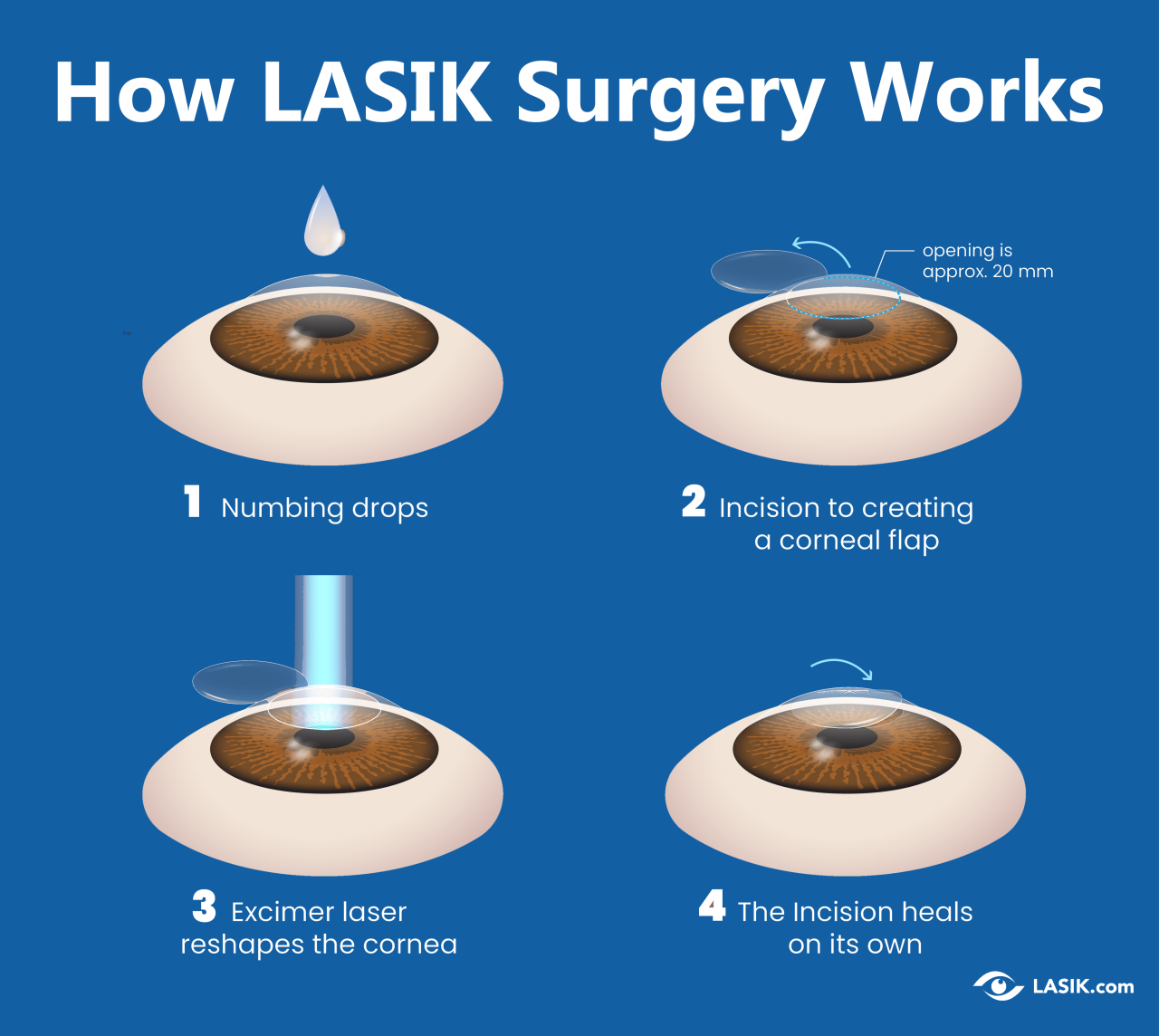 How Does Lasik Eye Surgery Work ™ Official Site