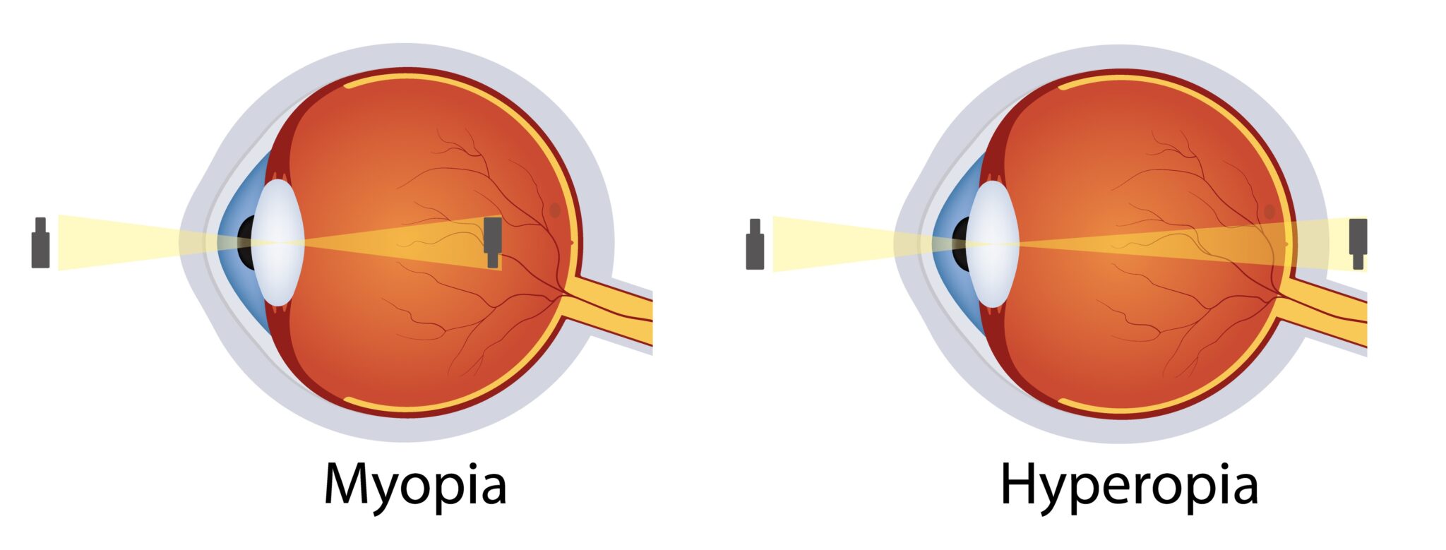 Myopia | LASIK.com™ Official Site