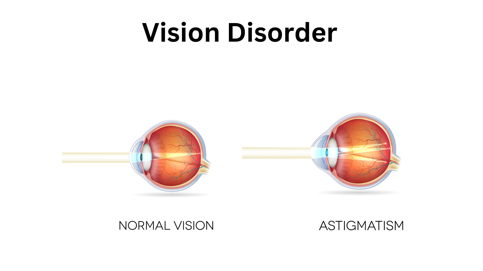 Astigmatism: Symptoms, Causes, and Treatment Options