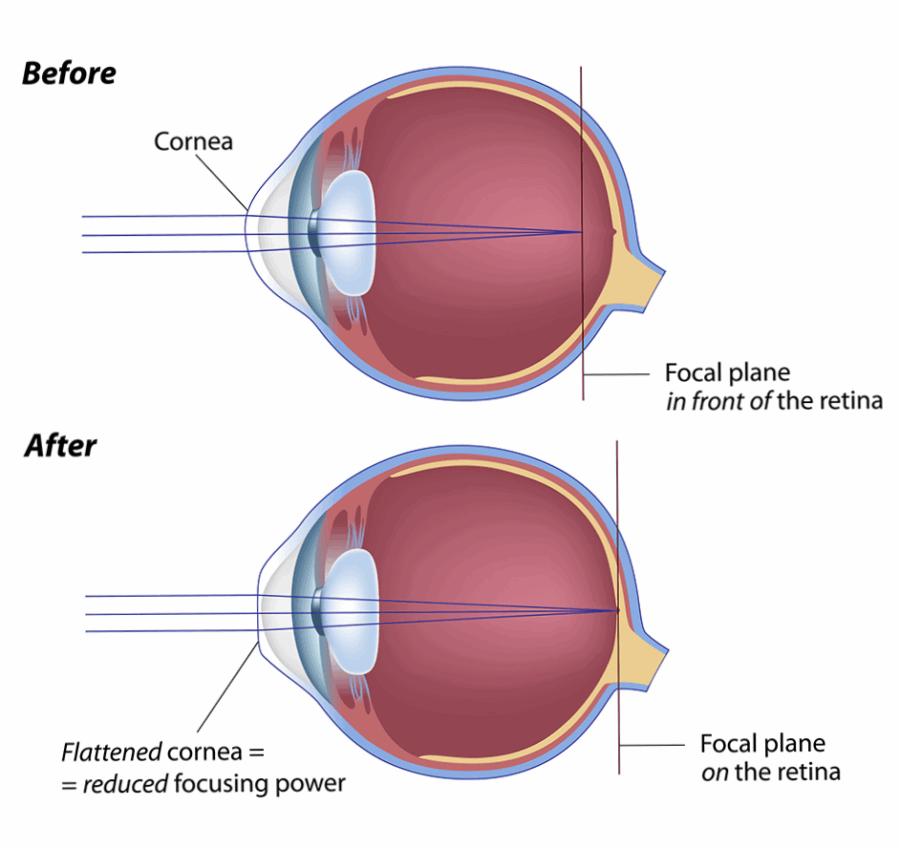 What is PRK Eye Surgery? | LASIK